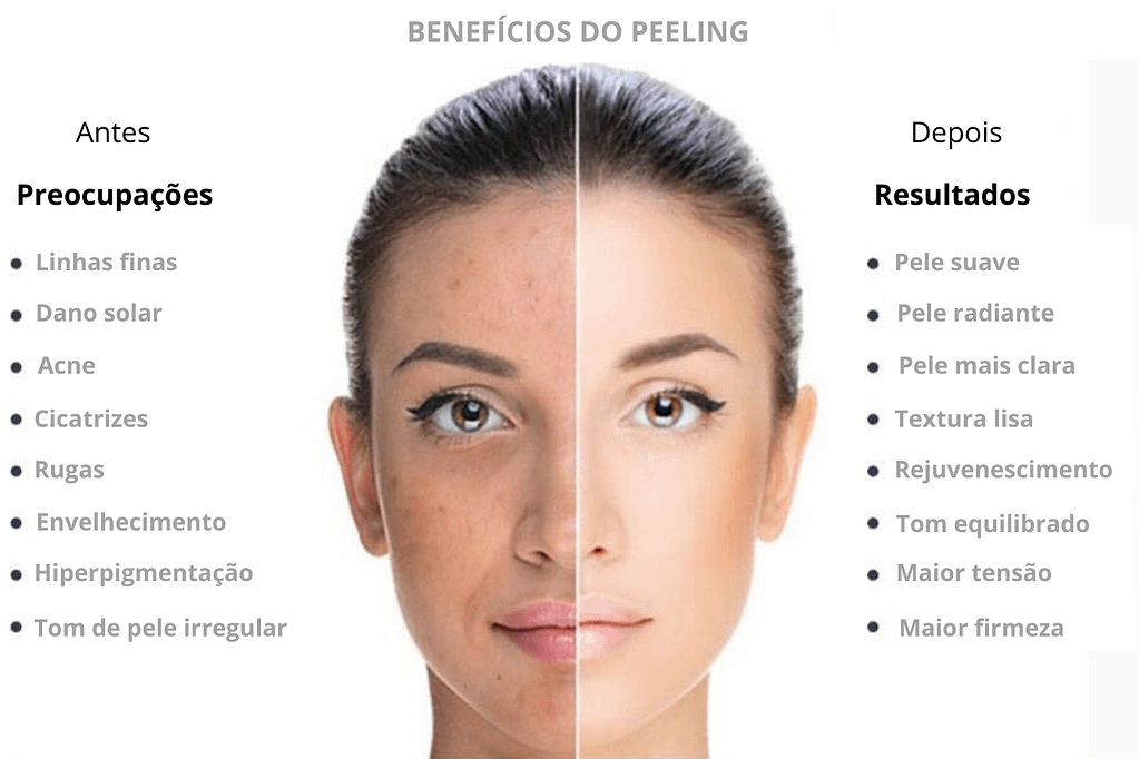 Peeling Químico - dra.leila lieva